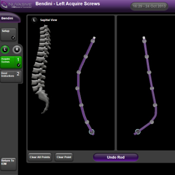 Minimally Invasive Spine Surgery Product | NOVO Engineering